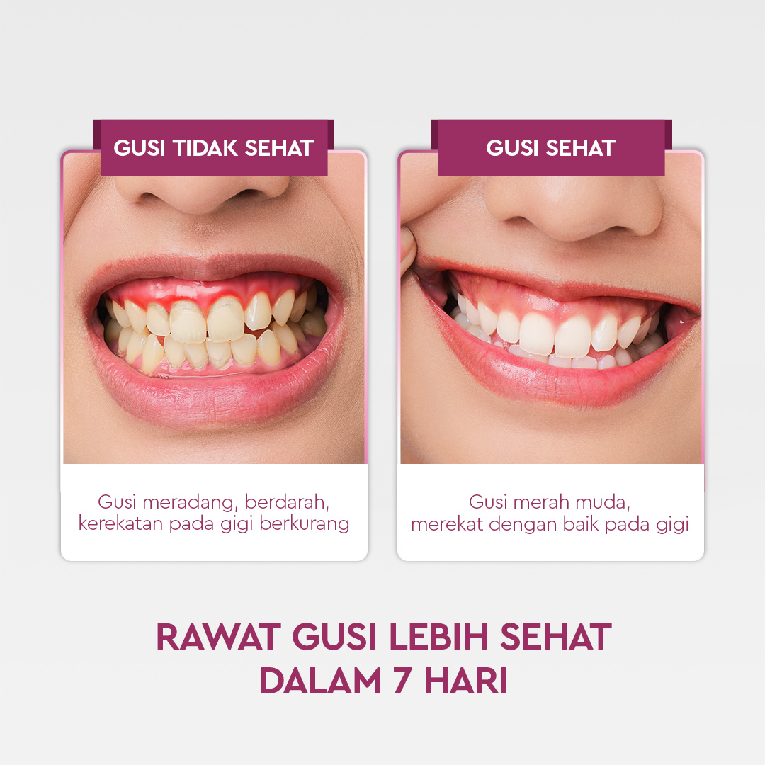 Jual Pepsodent Toothpaste Pasta Gigi Gum Expert Fresh Jaga Gusi Rekat ...