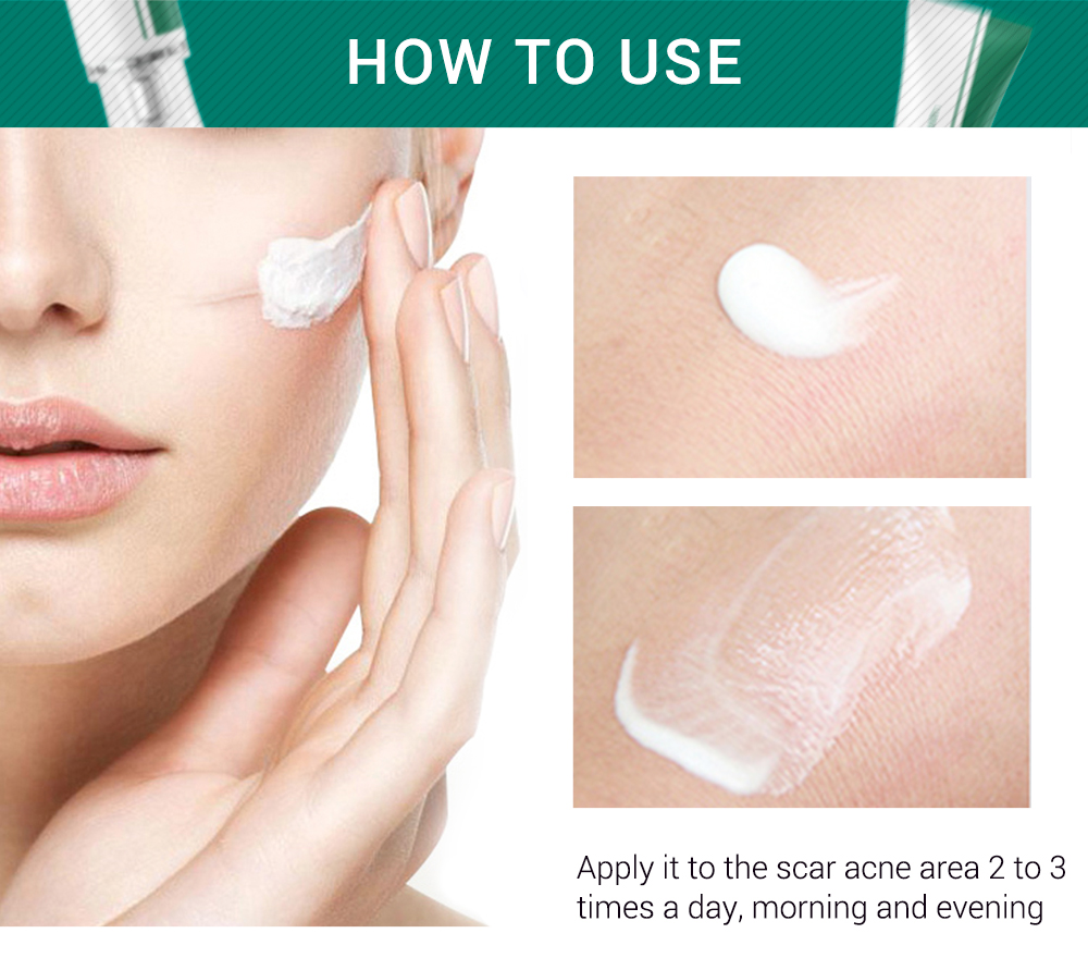 Jual 【BPOM】BREYLEE Acne Scar Removal - BREYLEE Penghilang Noda Bekas Jerawat, Luka & Stretch ...