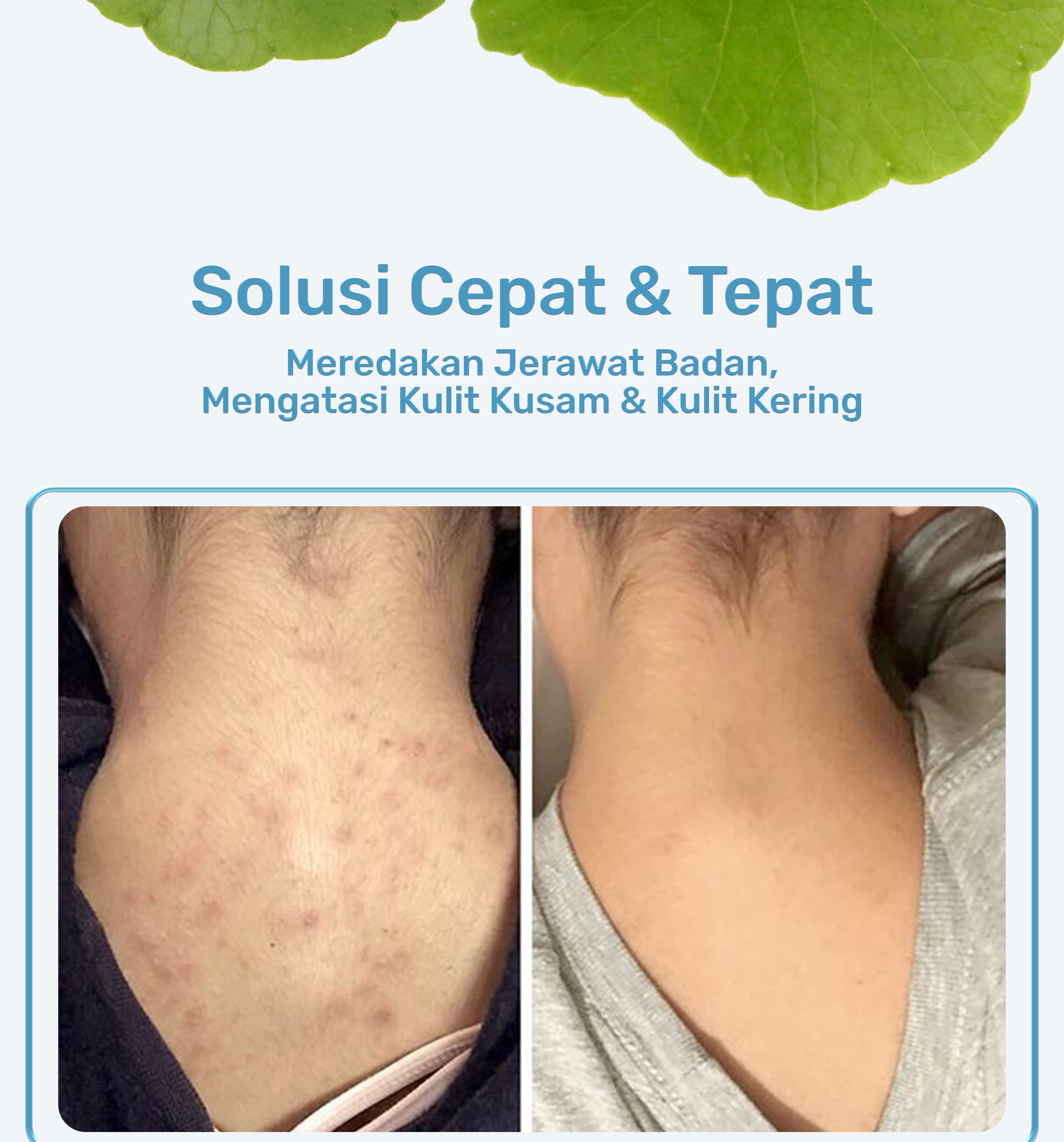Jual JEVARINE Acne Body Lotion Spotless Skin Untuk Jerawat Badan Kulit ...