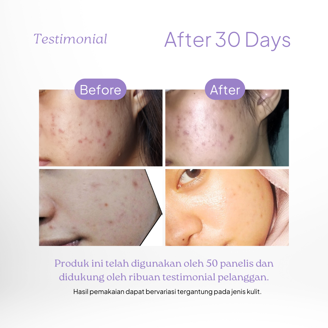 Jual [EXCLUSIVE PROMO B1G1] Dorskin Acne Set Skincare Matcha Glow ...