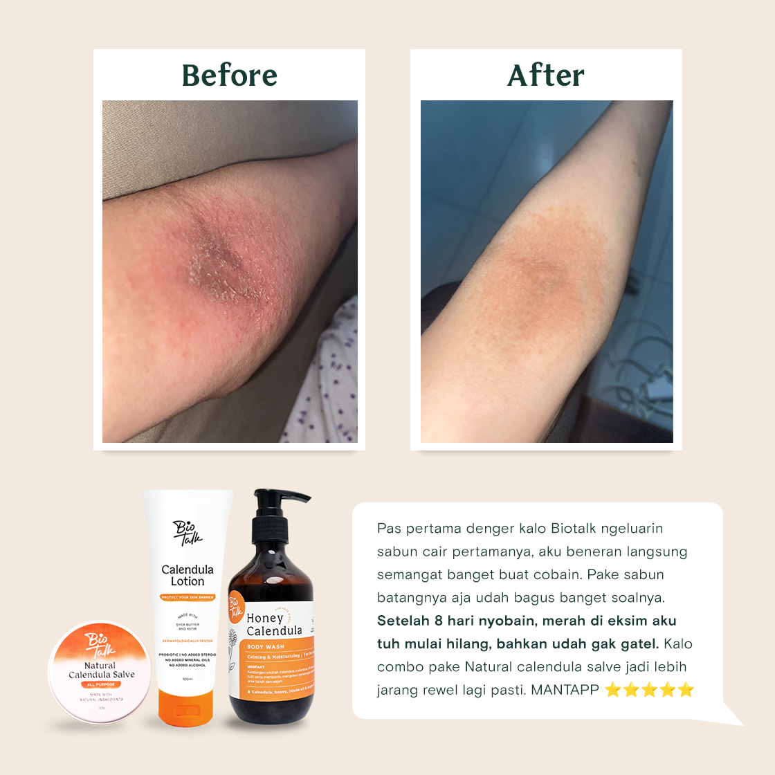 Jual Biotalk Bundle Eczema Psoriasis - Extra Calming | No SLS/SLES | Steroid Free | Sabun Mandi ...