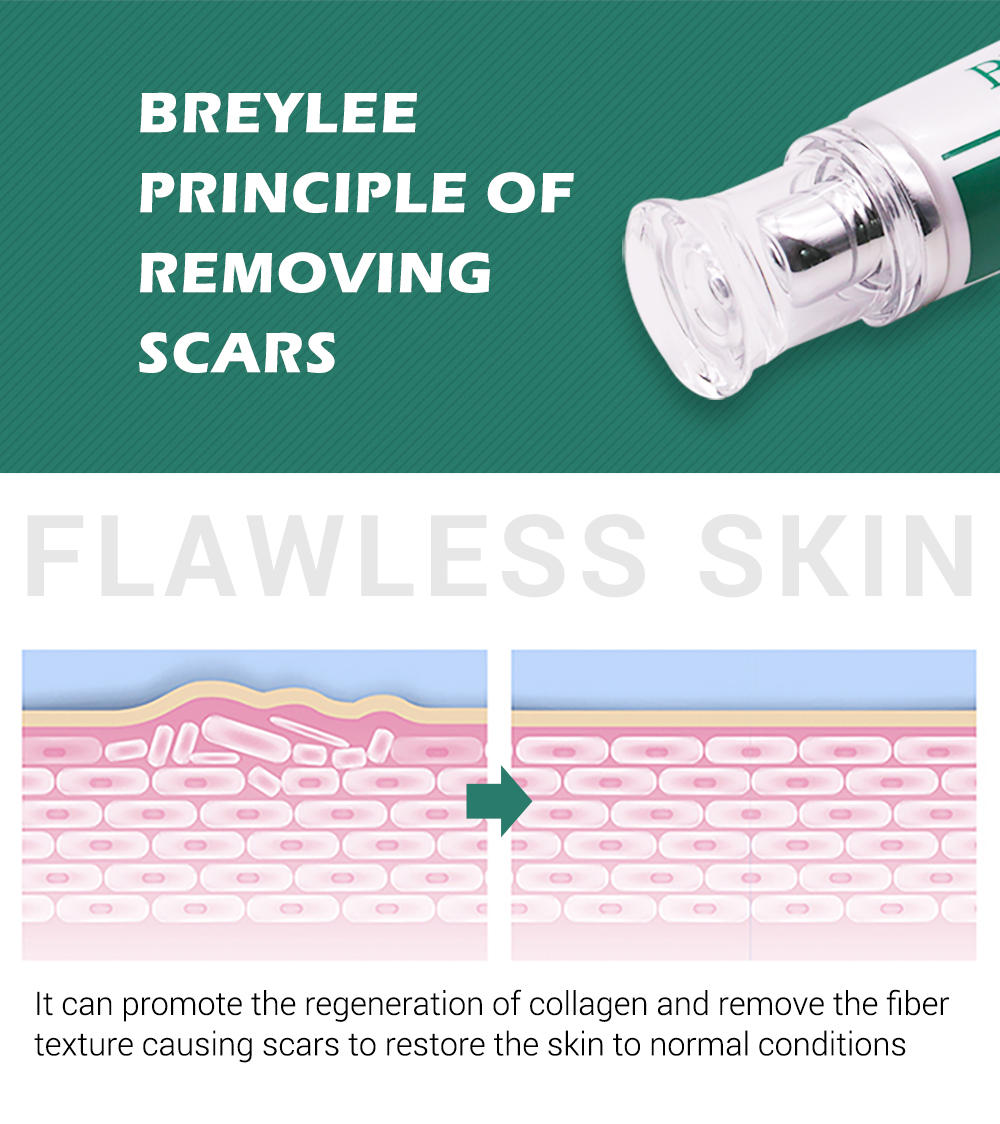 Jual 【BPOM】BREYLEE Acne Scar Removal - BREYLEE Penghilang Noda Bekas Jerawat, Luka & Stretch ...