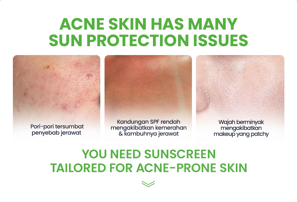 Jual YOU Sunbrella Pro Acnecare Shield Sunscreen SPF 50+ PA++++ Acne ...