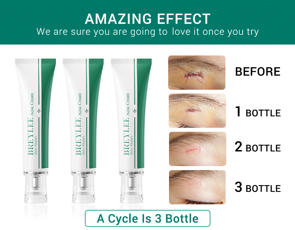 Jual 【BPOM】BREYLEE Acne Scar Removal - BREYLEE Penghilang Noda Bekas Jerawat, Luka & Stretch ...