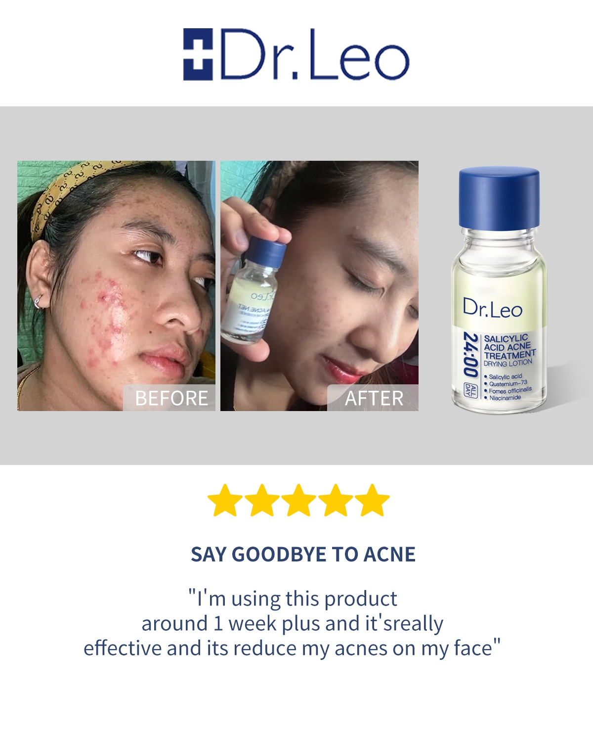 Jual Dr.Leo - Salicylic Acid Acne Essence Drying Lotion 10mL Serum ...