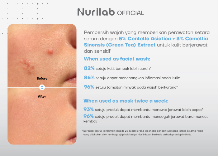 Jual Nurilab - Bundle Acne ClearSkin Solution | Acne Conclearing ...