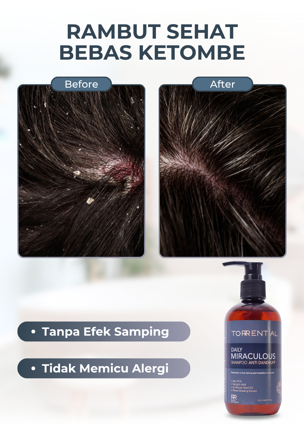 Jual TORRENTIAL | Shampo Anti Ketombe | Daily Miraculous Shampoo - Membantu Menjaga Kulit Kepala ...