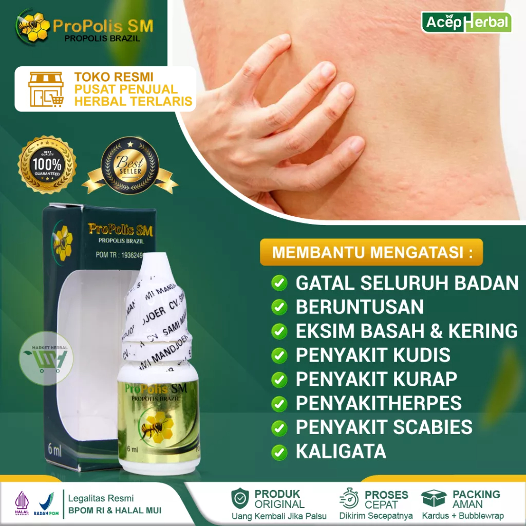 Jual Obat Gatal Gatal Seluruh Badan Eksim Kering Basah Kurap Kudis ...
