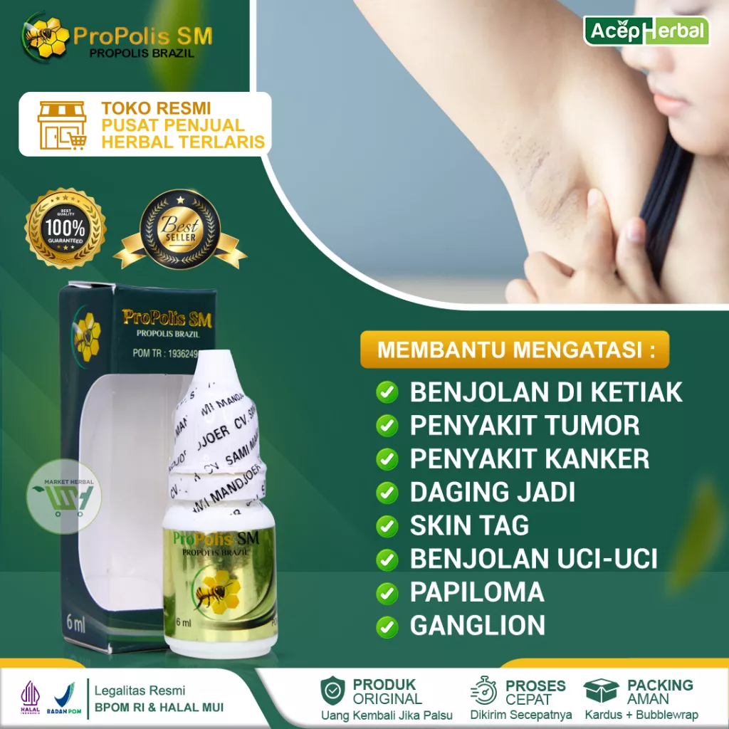 Jual Obat Benjolan Di Ketiak, Kelenjar Getah Bening, Menghilangkan ...