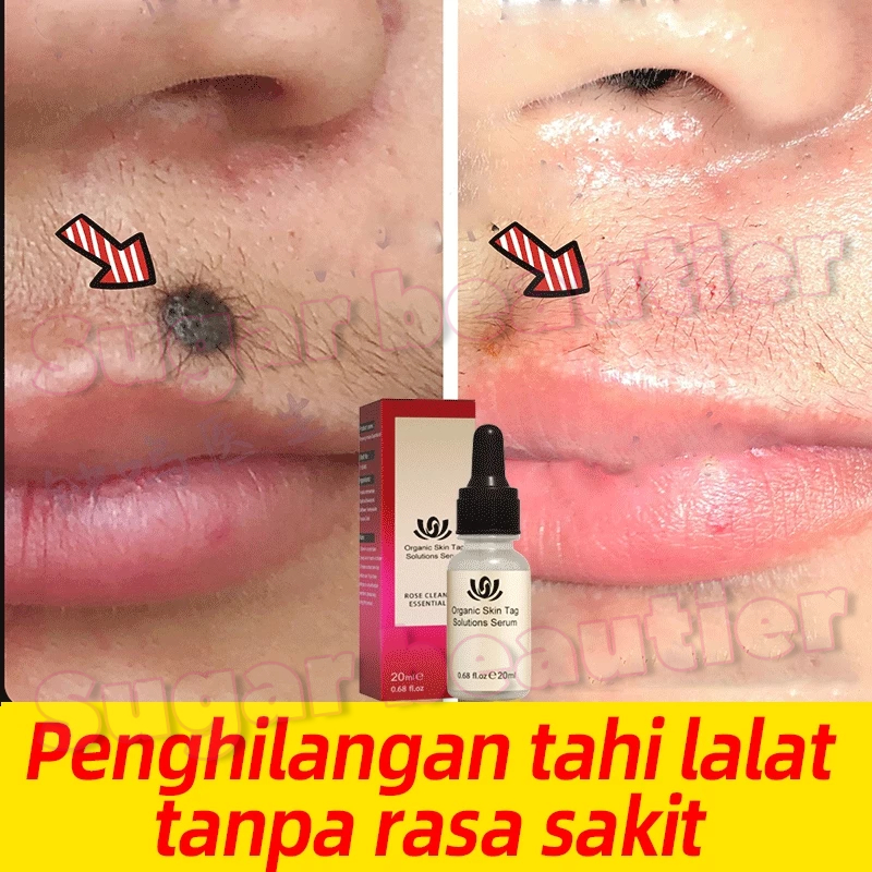 Jual Wart Removal Serum Penghilang Tahi Lalat Obat Penghilang Kutil ...