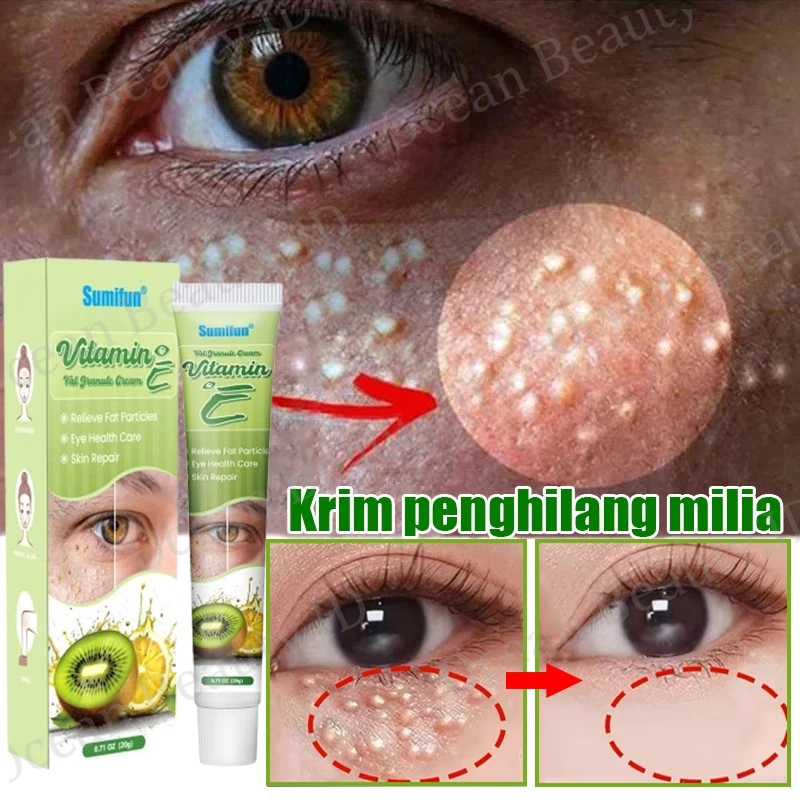 Jual Krim Penghilang Milia Salep Milia di Bawah Mata 20g Penghilang ...