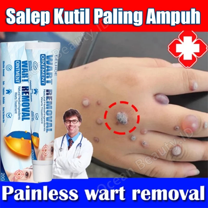 Jual Obat Kutil Paling Ampuh Krim Penghilang Kutil Wart Removal Cream ...
