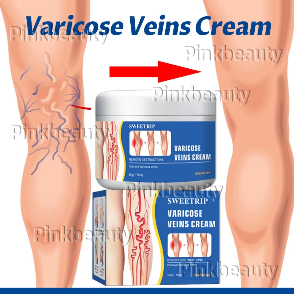 Jual SWEETRIP Varicose Veins Cream Obat Varises Di Kaki Dan Betis Ampuh ...