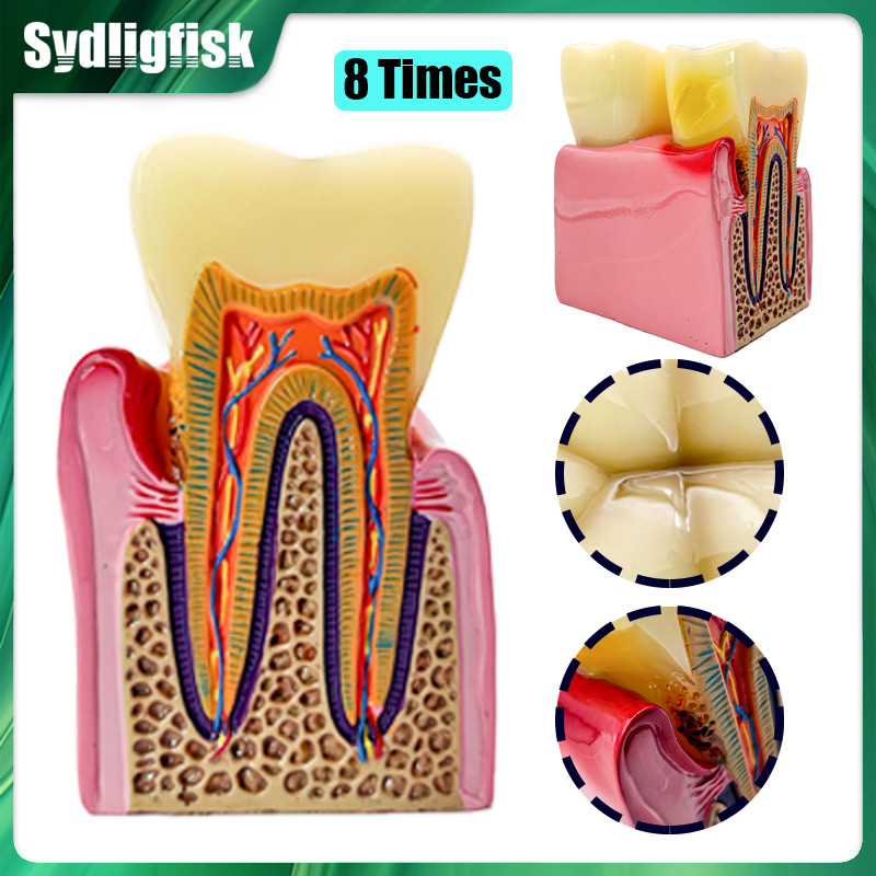 Jual New 8 Times Dental Caries Teeth Model Periodontitis Case Analysis ...
