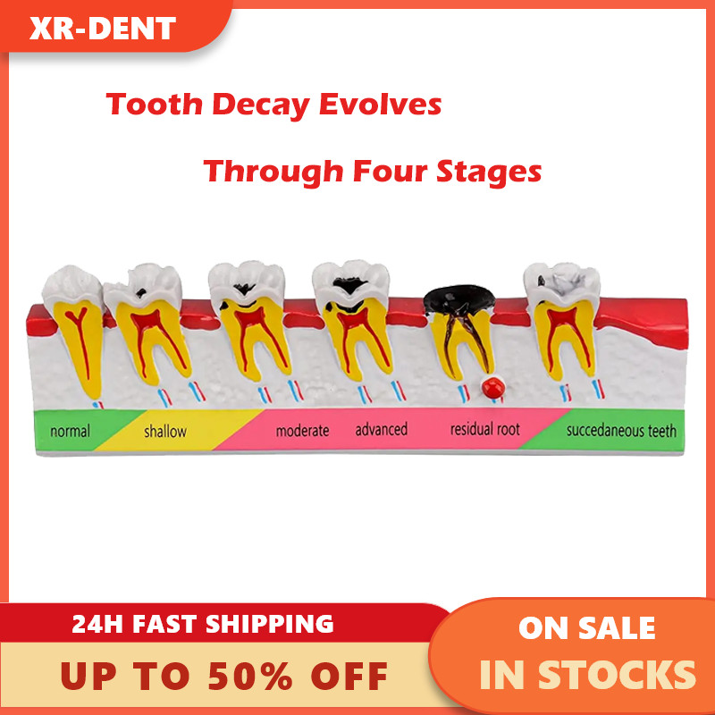Jual Teeth Periodontal Disease Model Dental Caries breakdown Display ...