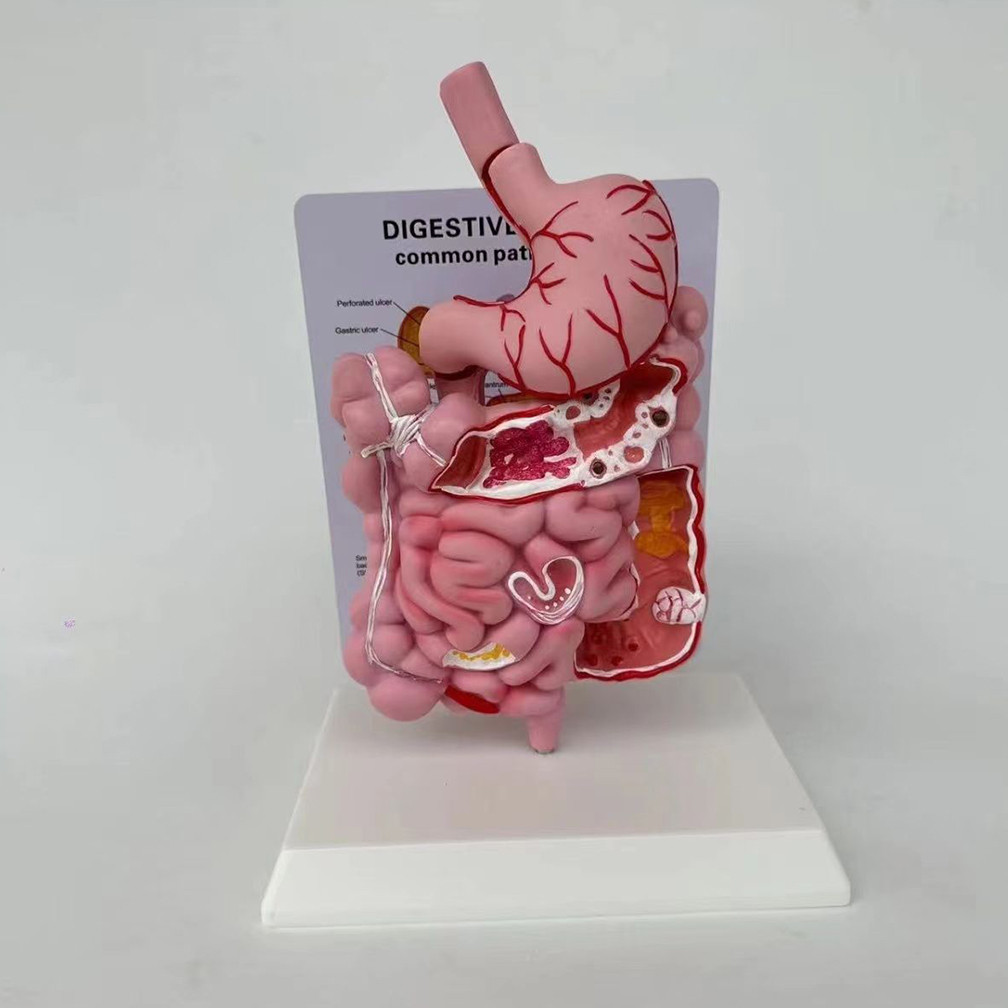 Jual New Adult Large Intestinal Pathology Model Human Digestive System ...