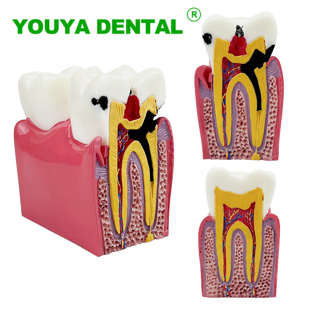 Jual Dental Study Teaching Model 6 Times Dental Caries Comparsion ...