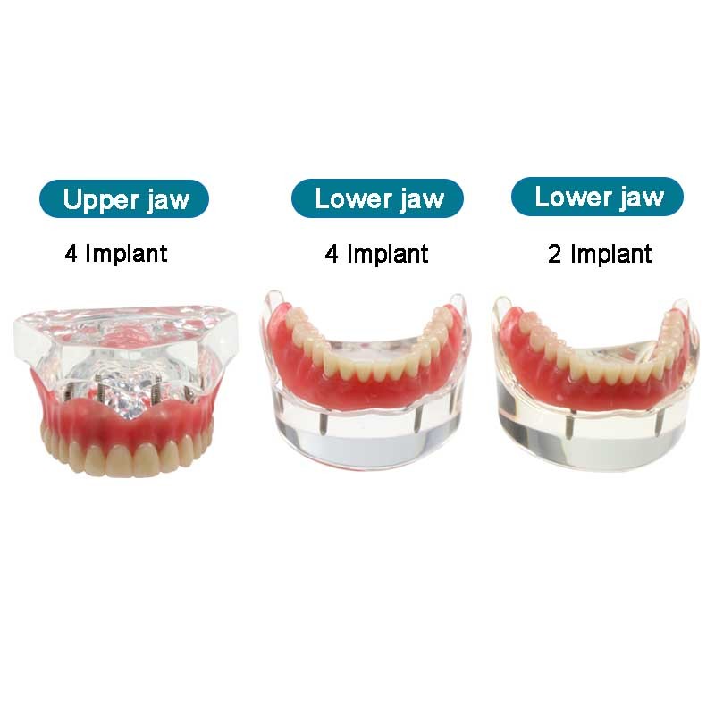 Jual Dental Teeth Model with Implant Overdenture Inferior Demo ...