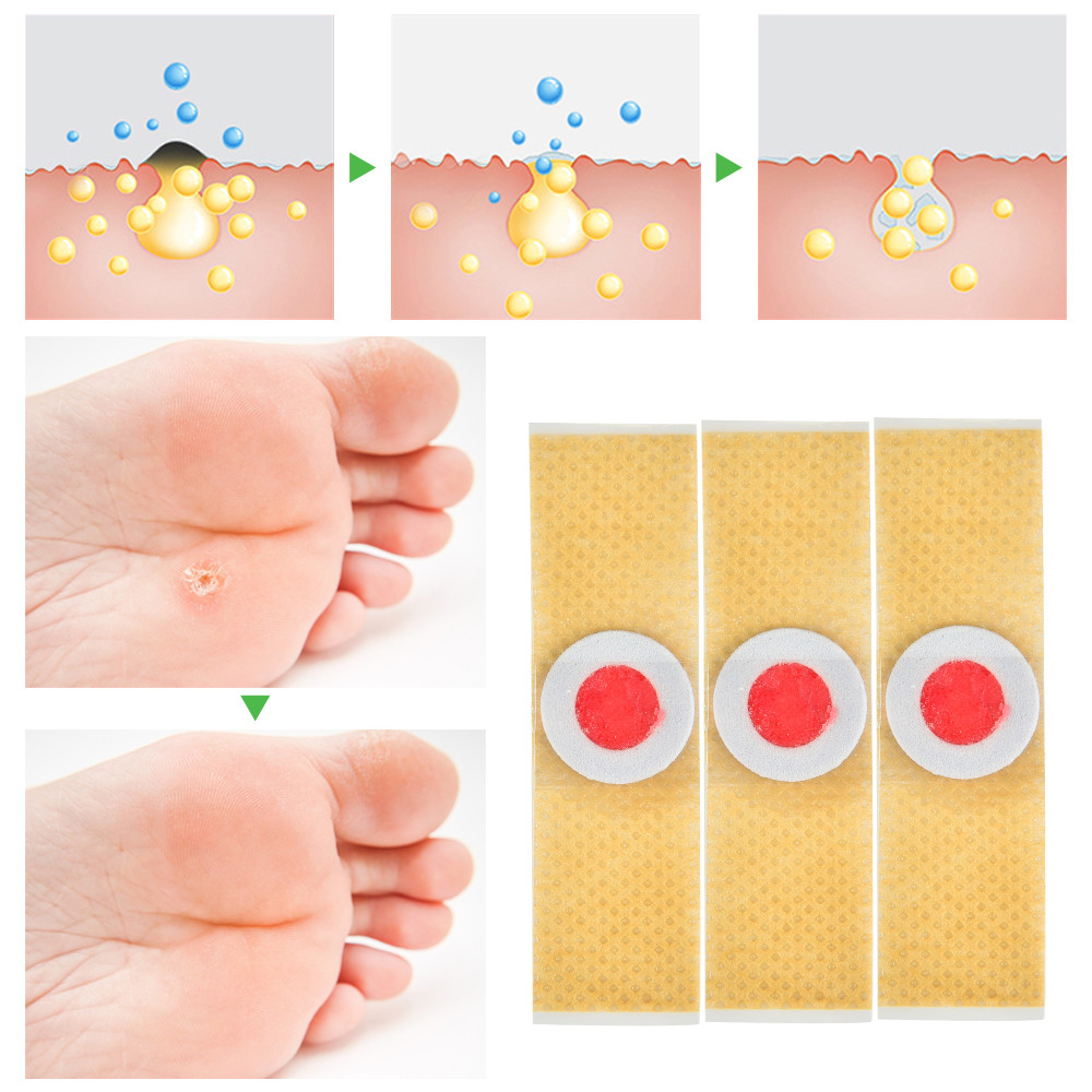 Jual 42PCS/Box Corn Patch Corn Plaster Remover Corn Toe Pads Patch ...
