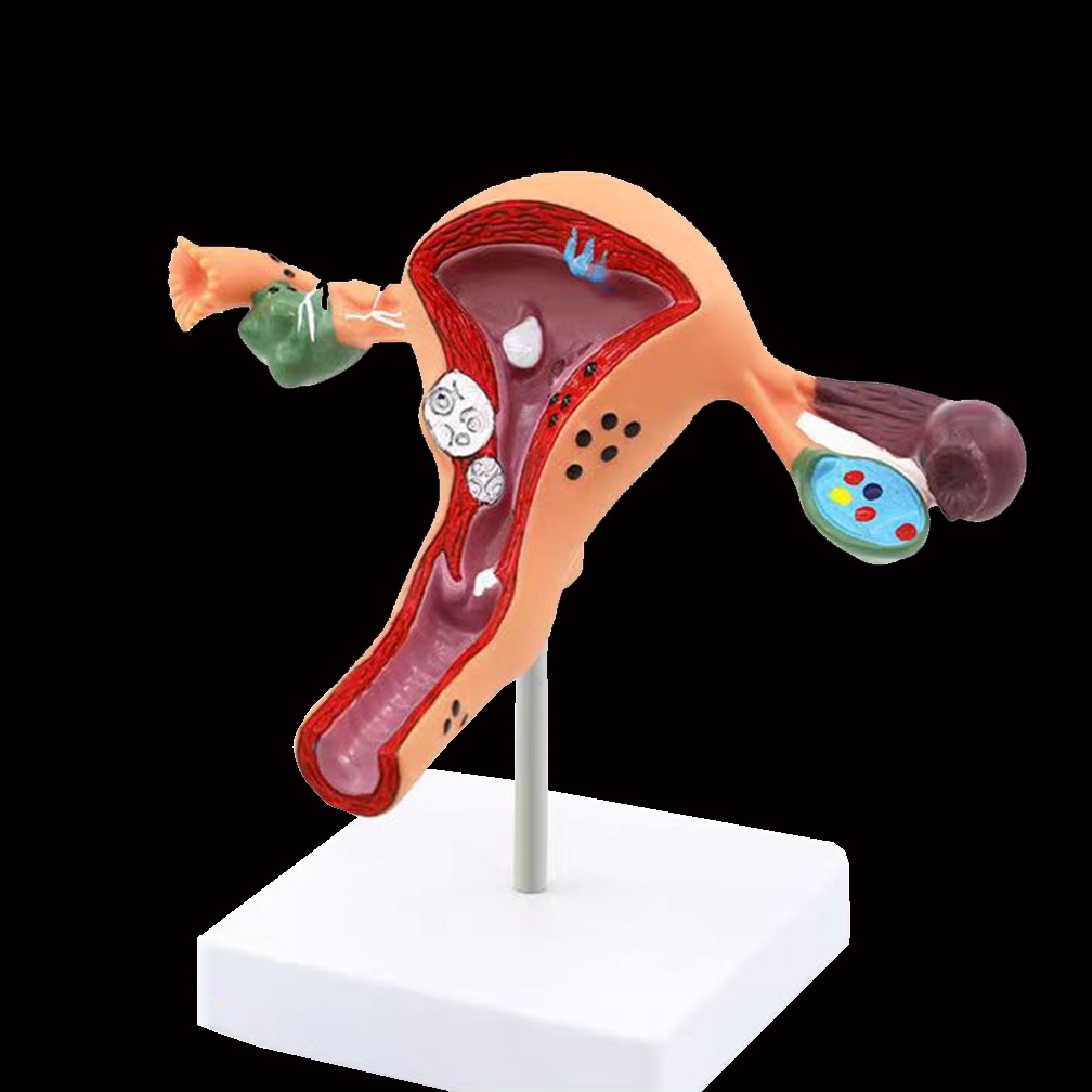 Jual NEW Medical Props Model Human Pathological Uterus Ovary Model ...