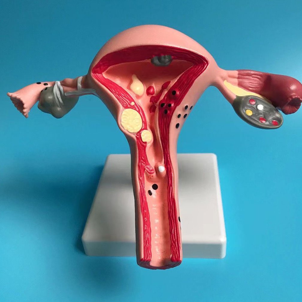 Jual New New Human Pathological Uterus Ovary Model Cross Section ...