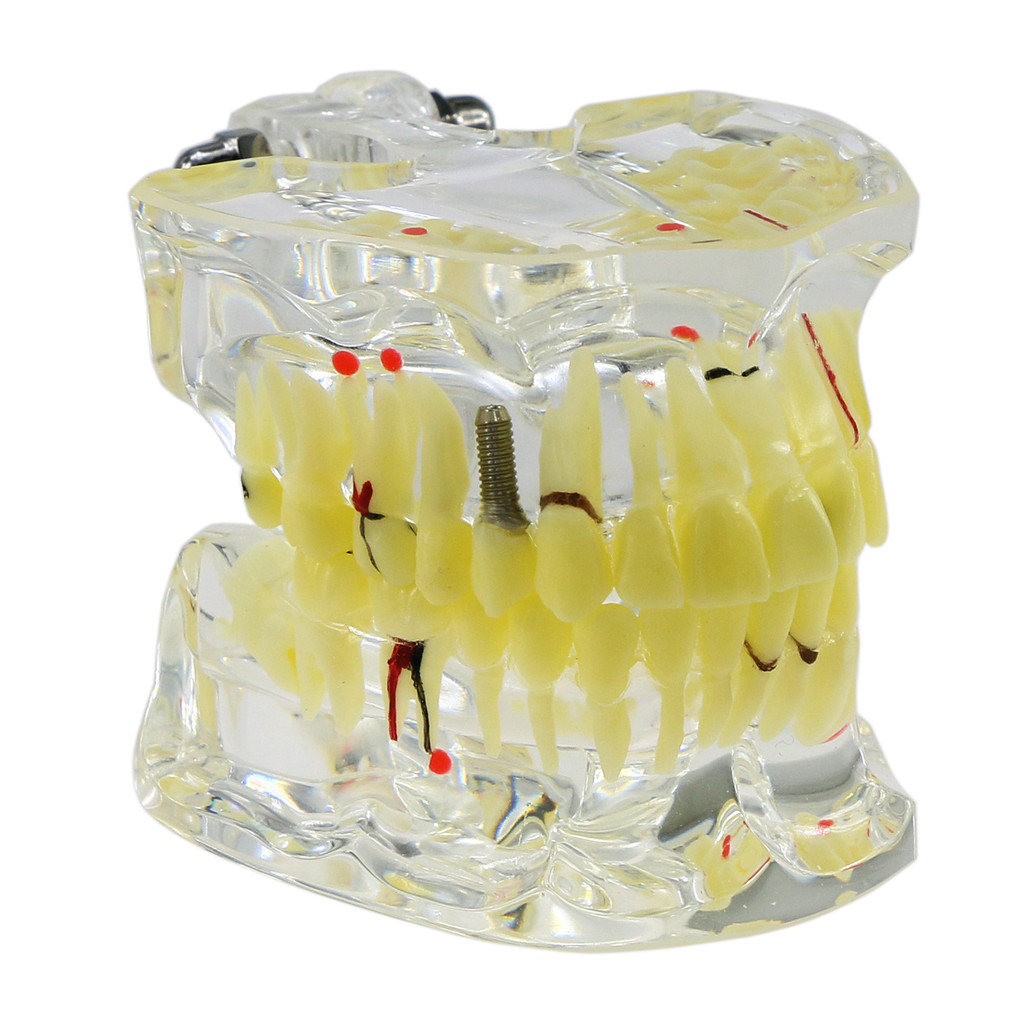 Jual Dental Adult Model Typodont Caries Apical Cyst Impacted Wisdom ...