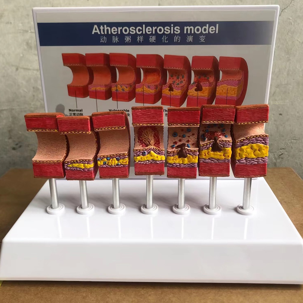 Jual New 7 Stages In 1 Arterial Vessel Atherosclerosis Model Middle ...
