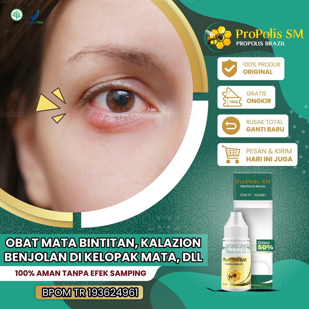 Jual Obat Mata Bintitan Kalazion Timbilan Mata Timbilan Bernanah Mata ...