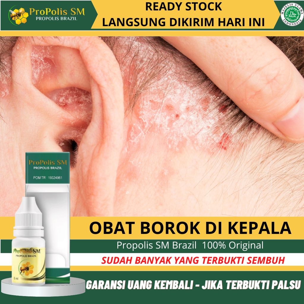 Jual Obat Psoriasis Kulit Kepala, Kepala Bersisik, Kulit Kepala Bayi Dewasa Borok, Ketombe Parah ...