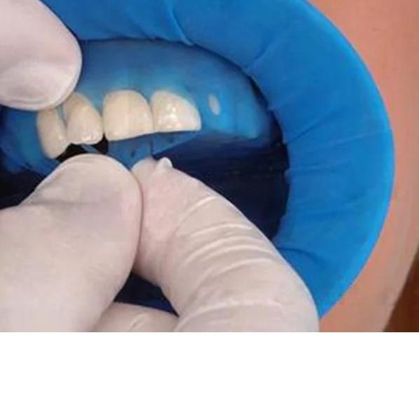 Jual Alice dental // rubber dam rubberdam mouth opener retractor ...