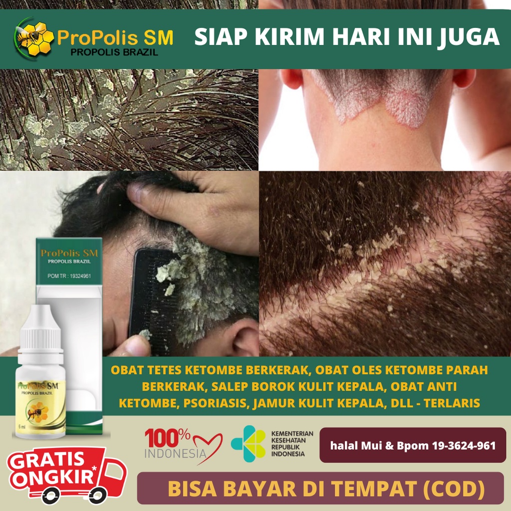 Jual Obat Penghilang Gatal di Kulit Kepala Akibat Infeksi Jamur, Psoriasis, Ketombe Parah ...