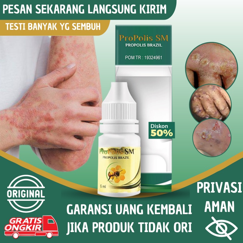 Jual Obat Budug dan gatal, Obat Budug santri, Obat Gudig / Gudik, Obat ...