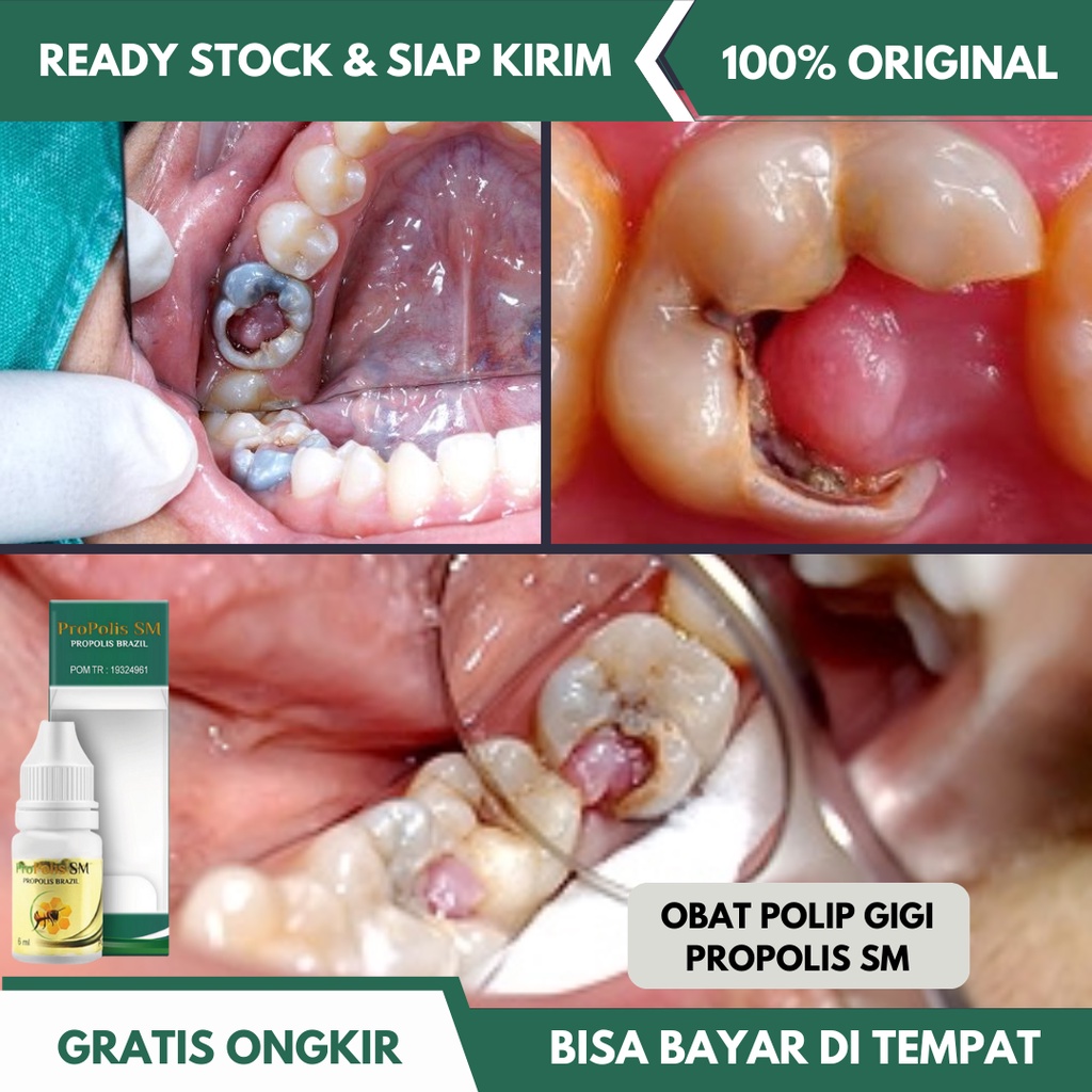 Jual Obat Polip Gigi, Polip Pulpa Gigi, Sakit Gigi dan Gusi Bengkak ...