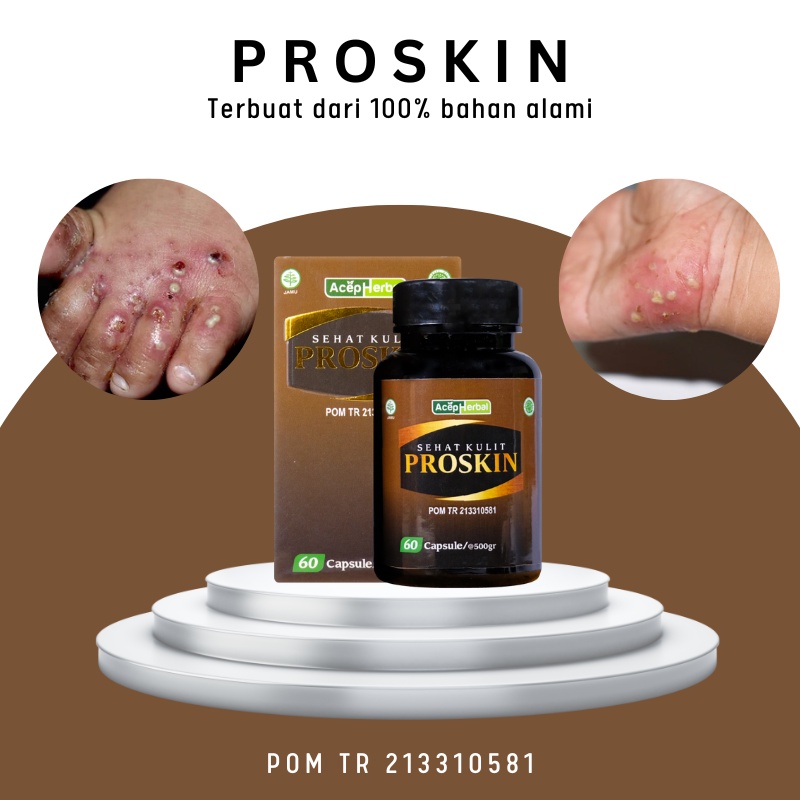 Jual Kaka Herbal - Obat Budug Bernanah, Obat Scabies Manusia, Obat ...