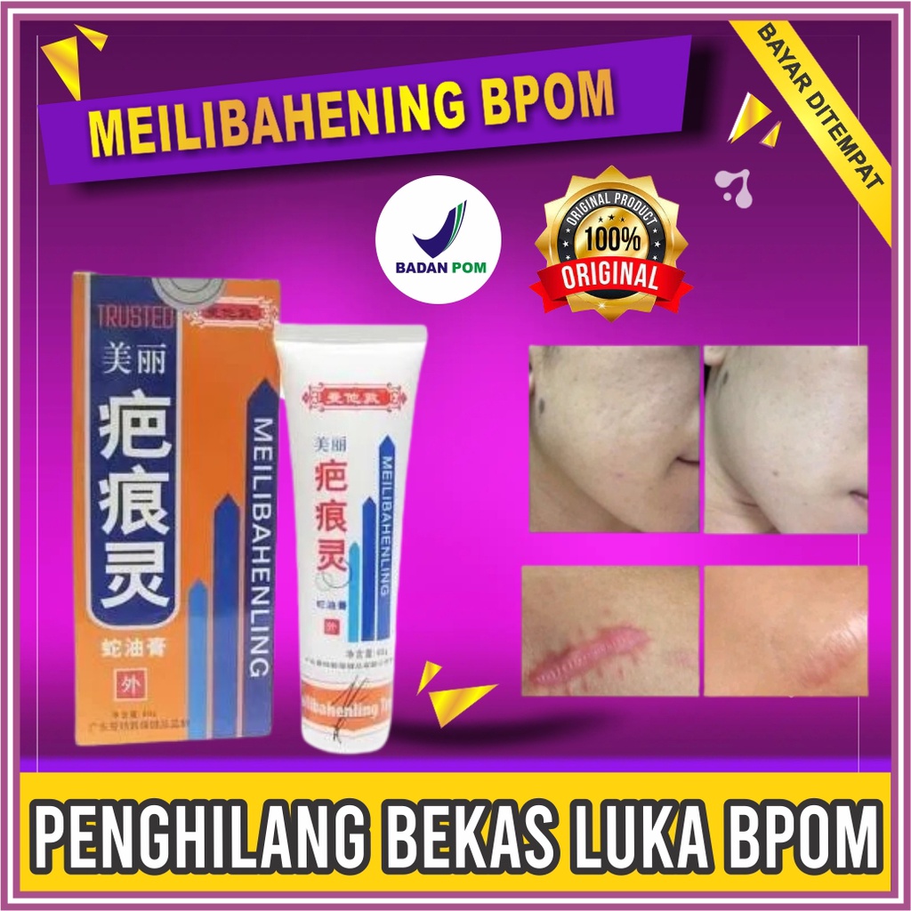 Jual cream salep penghilang bekas luka bakar sayatan pemudar stretch ...