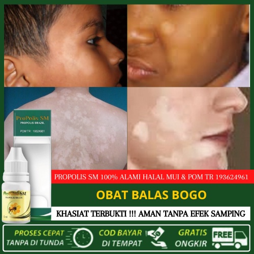 Jual Obat Herbal Penghilang Balas Bogo Bercak Putih Di Wajah Meratakan ...