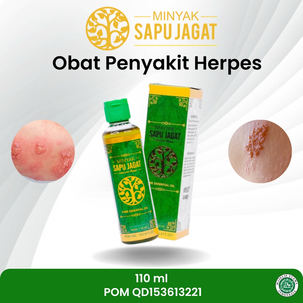 Jual Sapnu Herbal - Obat Herpes, Herpes kulit, Penyakit Herpes, Herpes ...