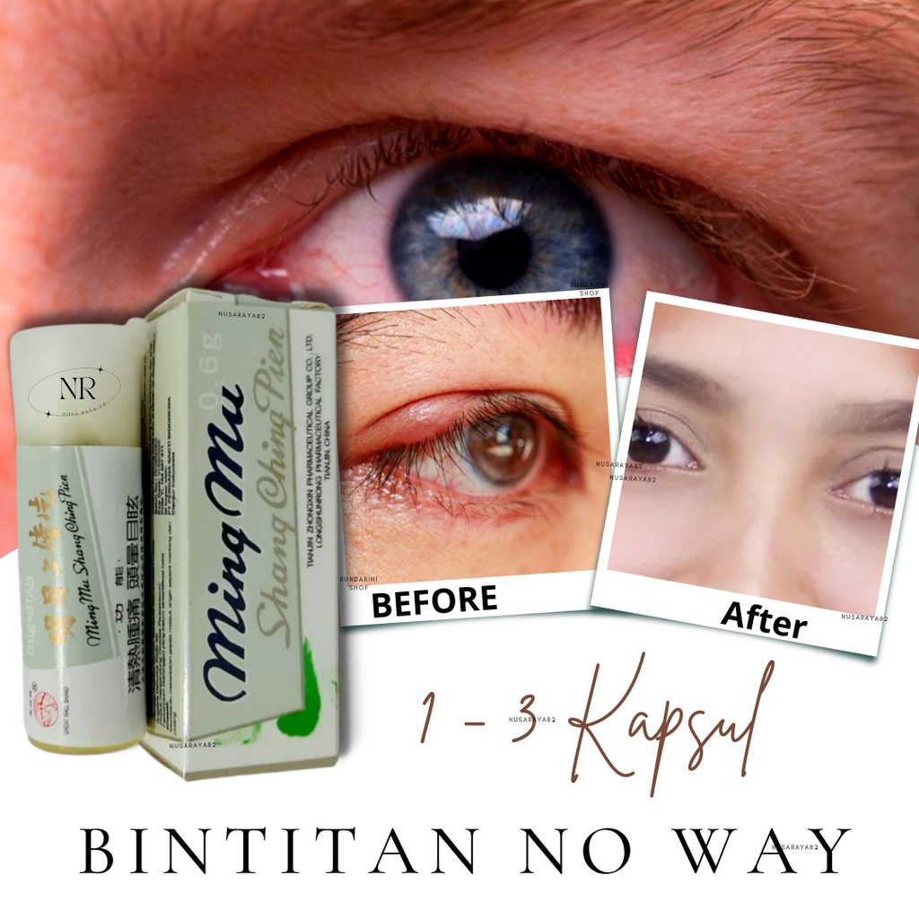 Jual Obat Penghilang Mata Bintitan Timbilan Kelopak Mata Ming Mu Shang Ching Pien Pengempis Mata ...