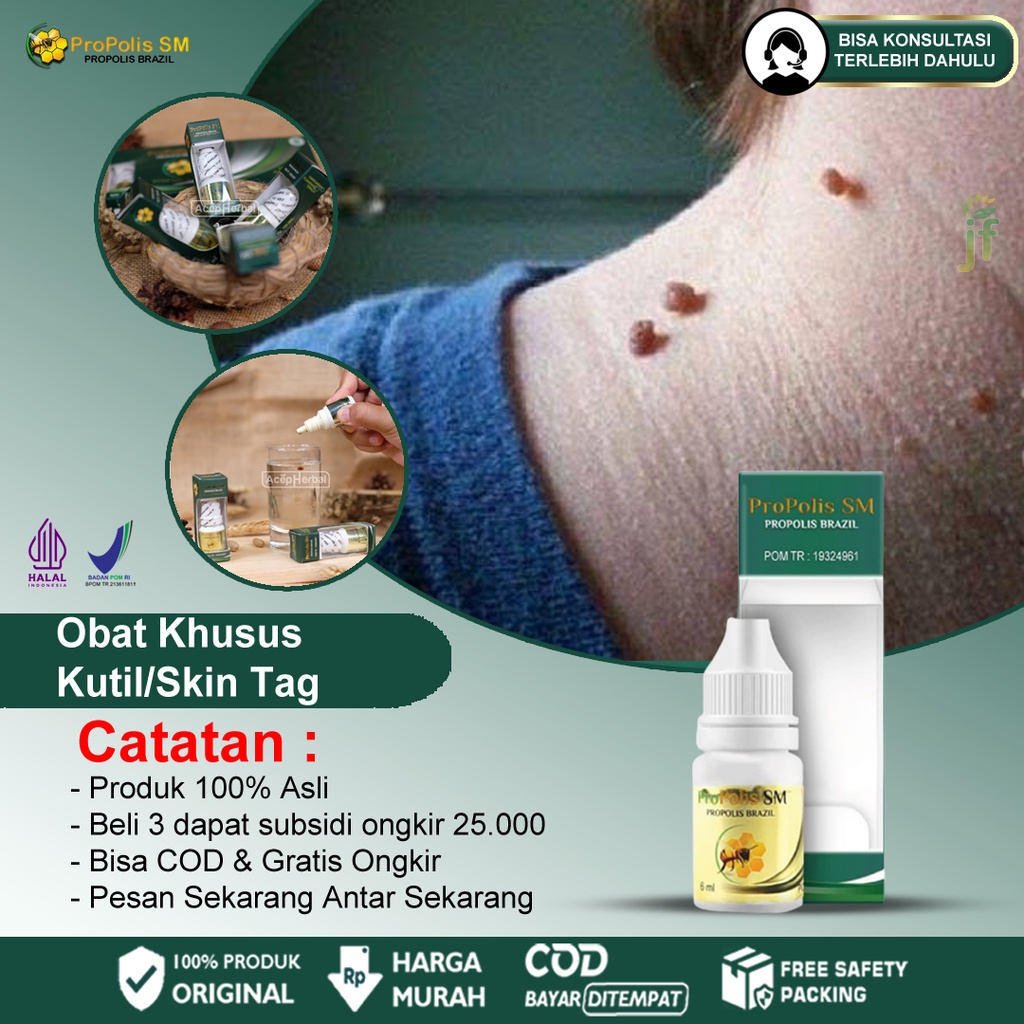 Jual Obat Kutil Skin Tag Milia Daging Jadi Mata Ikan Lipoma Kelenjar ...