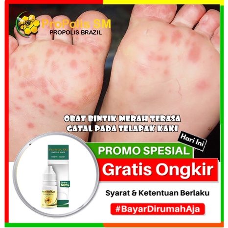 Jual Obat Bintik Merah Terasa Gatal Pada Telapak Kaki | Penghilang ...