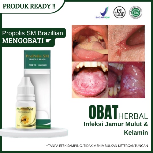Jual Propolis SM Obat Infeksi Jamur Di Kulit Mulut Dan Kelamin - Obat ...