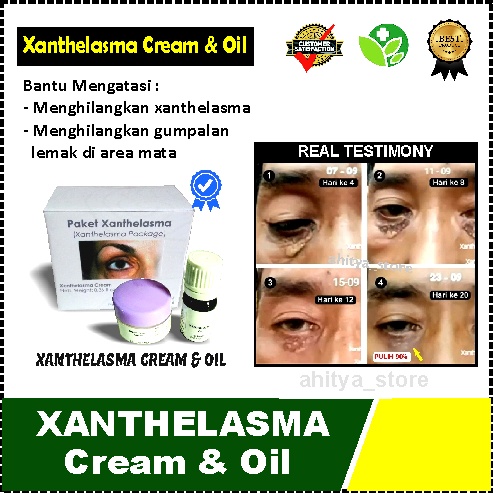 Jual Xanthelasma Cream Penghilang Gumpalan Lemak di Kelopak Mata ...