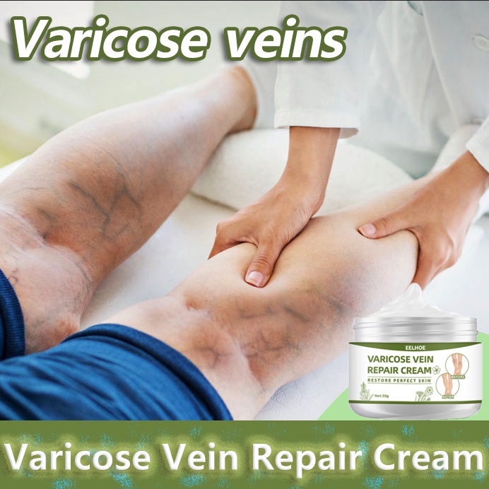 Jual Obat varises Varises Cream50g Efektif Permanen Krim Varises Cream ...