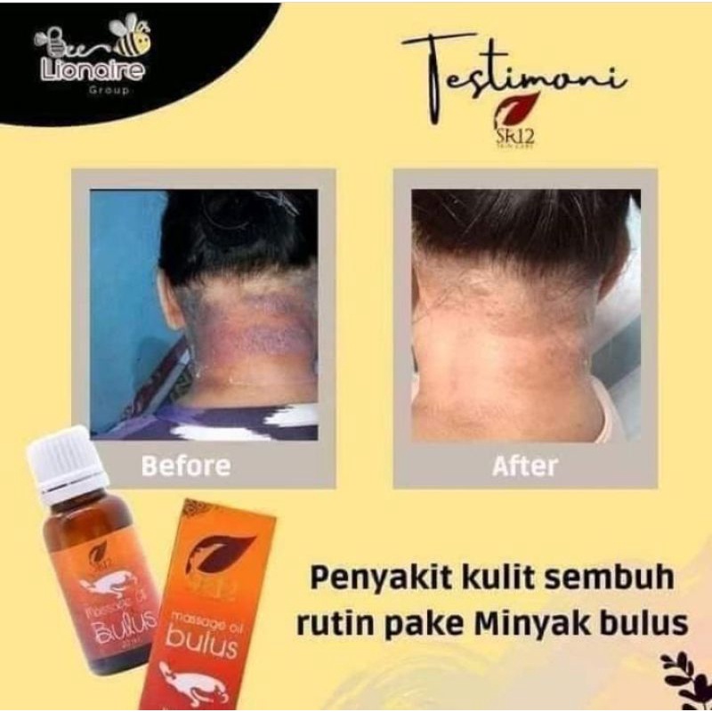Jual SR12 Minyak Bulus Obat Gatal Kulit Eksim Jamur Scabies ...