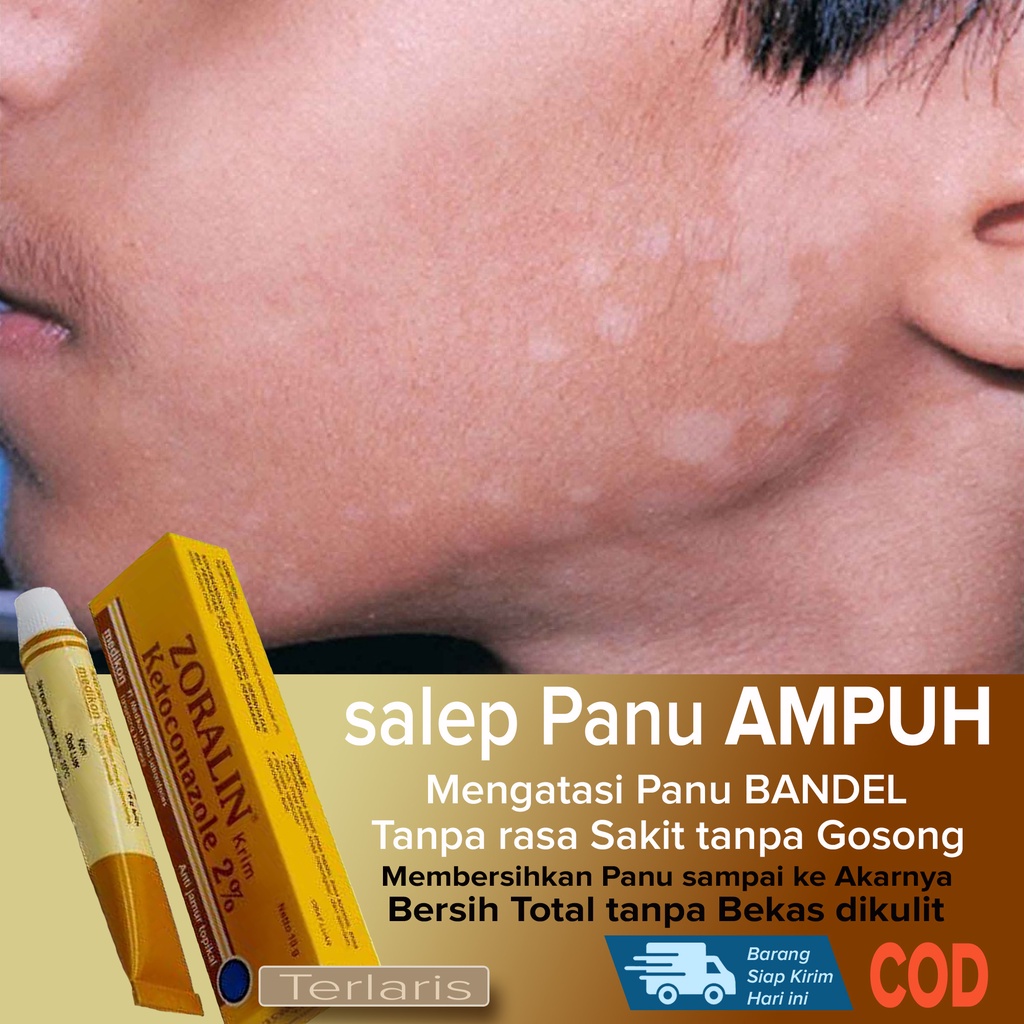 Jual BEST SELLER salep Obat Panu BANDEL Ampuh Membersihkan Jamur Panu sampai ke Akarnya ...