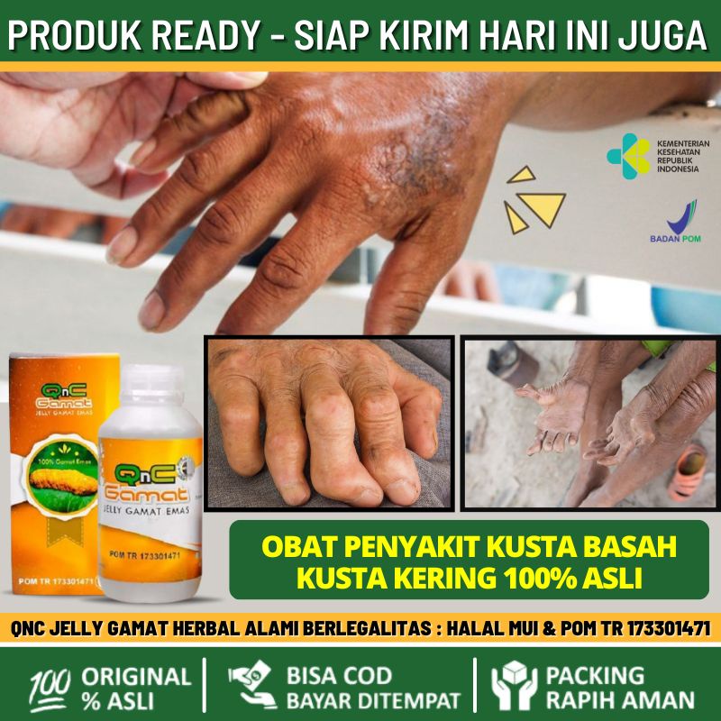 Jual Obat Untuk Penyakit Kusta Herbal, Obat Kusta Basah & Kusta Kering ...