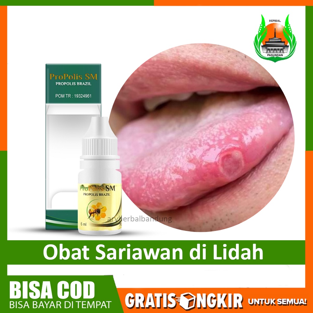 Jual Obat Sariawan di Lidah Luka di Bawah Lidah Sariawan Di Pinggir ...