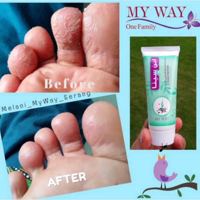 Jual Ibnu Sina MY WAY obat krim untuk gatal ,kaki pecah pecah, obat ...
