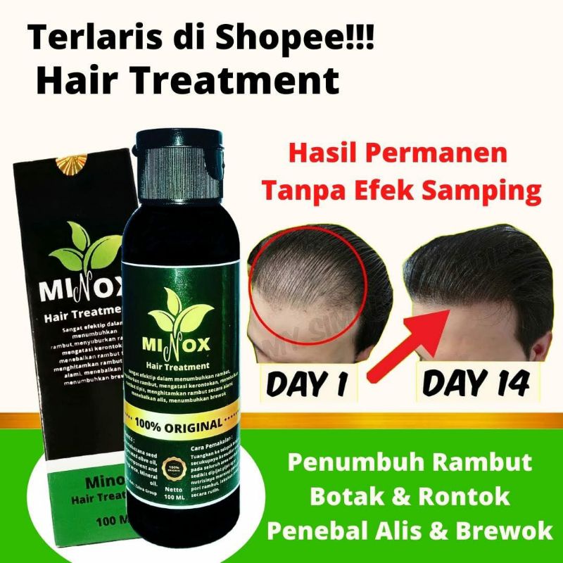 Jual Paket 5 Botol Minox Hair Treatment Penumbuh Rambut Botak dan ...