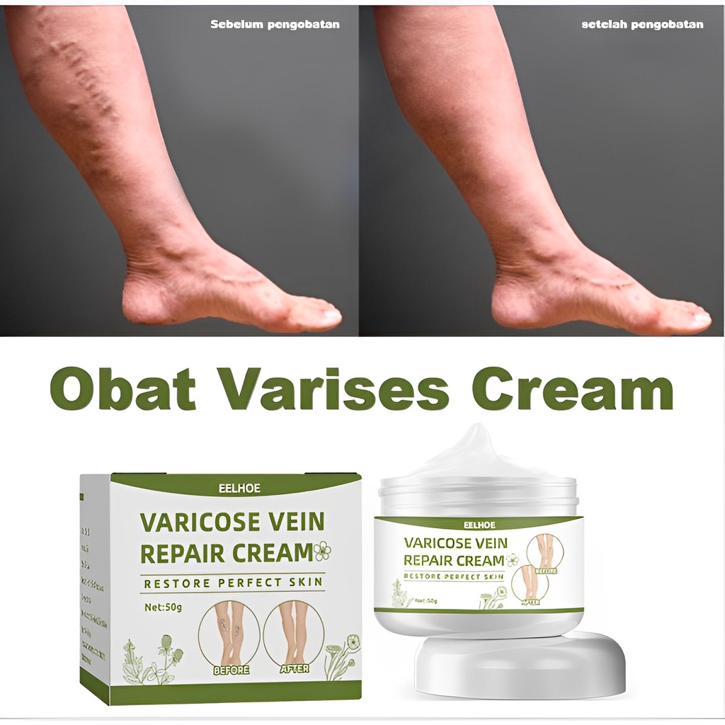 Jual Obat varises Varises Cream Salep Penghilang Bekas Penghilang ...